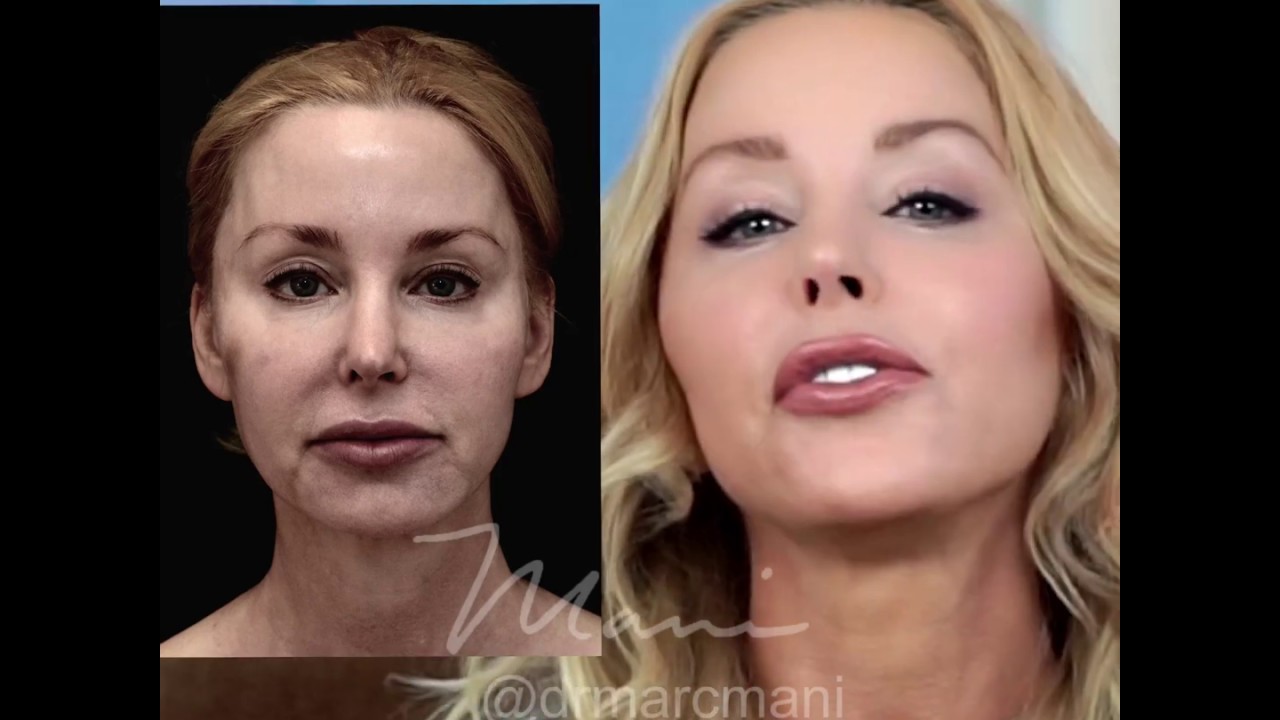 Dr. Marc Mani performs his HD Lift™️ on Darnell Cox of ...