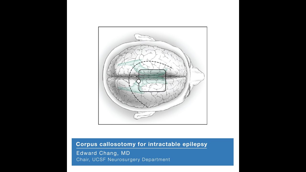 Corpus Callosotomy for Intractable Epilepsy (1min. trailer), Edward ...
