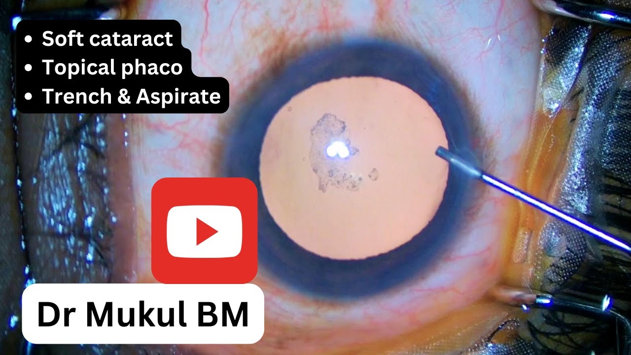 SOFT CATARACT -TRENCH & ASPIRATE #manjushreeeyecare #KGF #cataract # ...