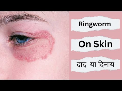 DAAD AND DINAY HUMARE SARIR ME KYU HOTA HAI | WHY RINGWORM ON SKIN ...