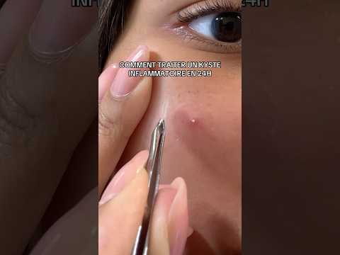 💡 Ne touchez pas le bouton si vous avez peur de le triturer, vous allez approfondir la tache #acne