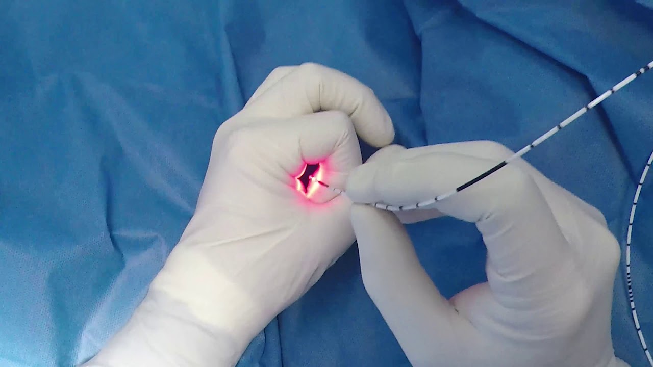 filac fibra laser 360 2 - YouTube