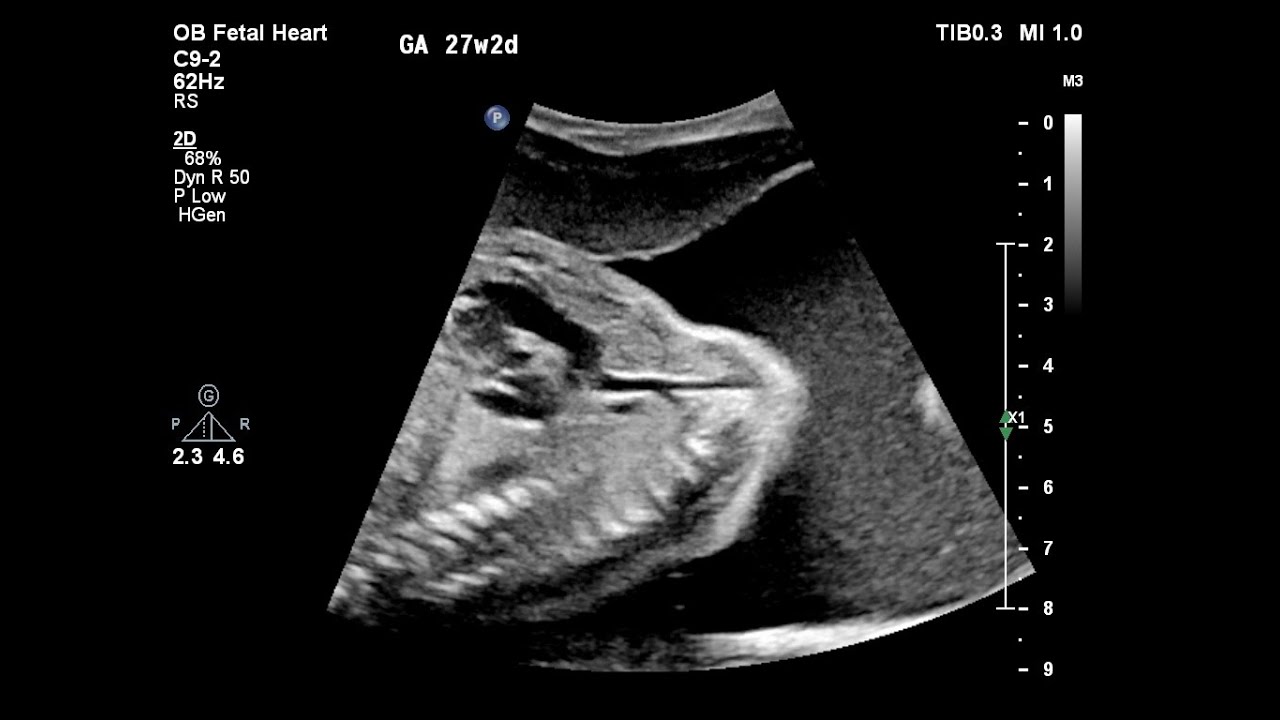 Fetus 27w, IUGR, Interrupted Aortic Arch (IAA) type B, LSVC - YouTube