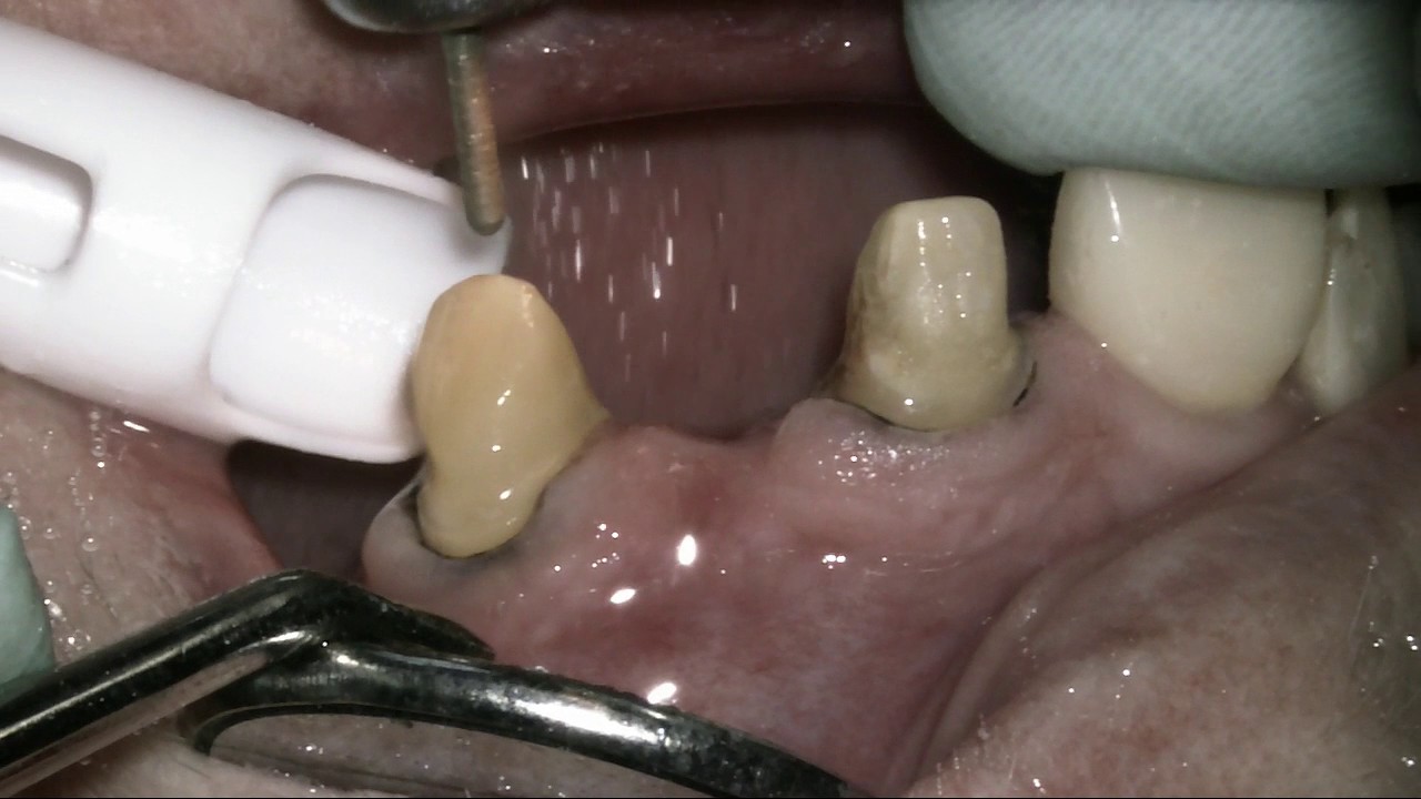 #9-11 Bridge Preparation Part 4 - YouTube