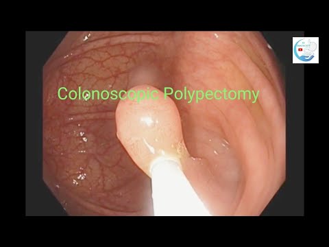 Colonoscopic Polypectomy procedure done by Professor Dr Hasan Masud at ...