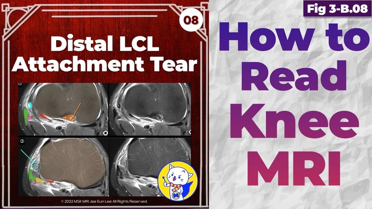 (Fig 3-B.08) Distal LCL Attachment Tear - YouTube