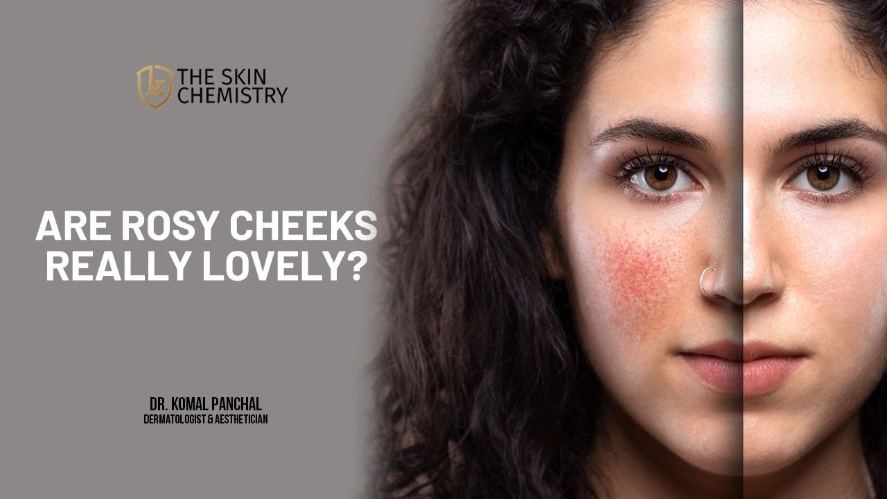 Are Rosy Cheeks really Lovely?? - YouTube