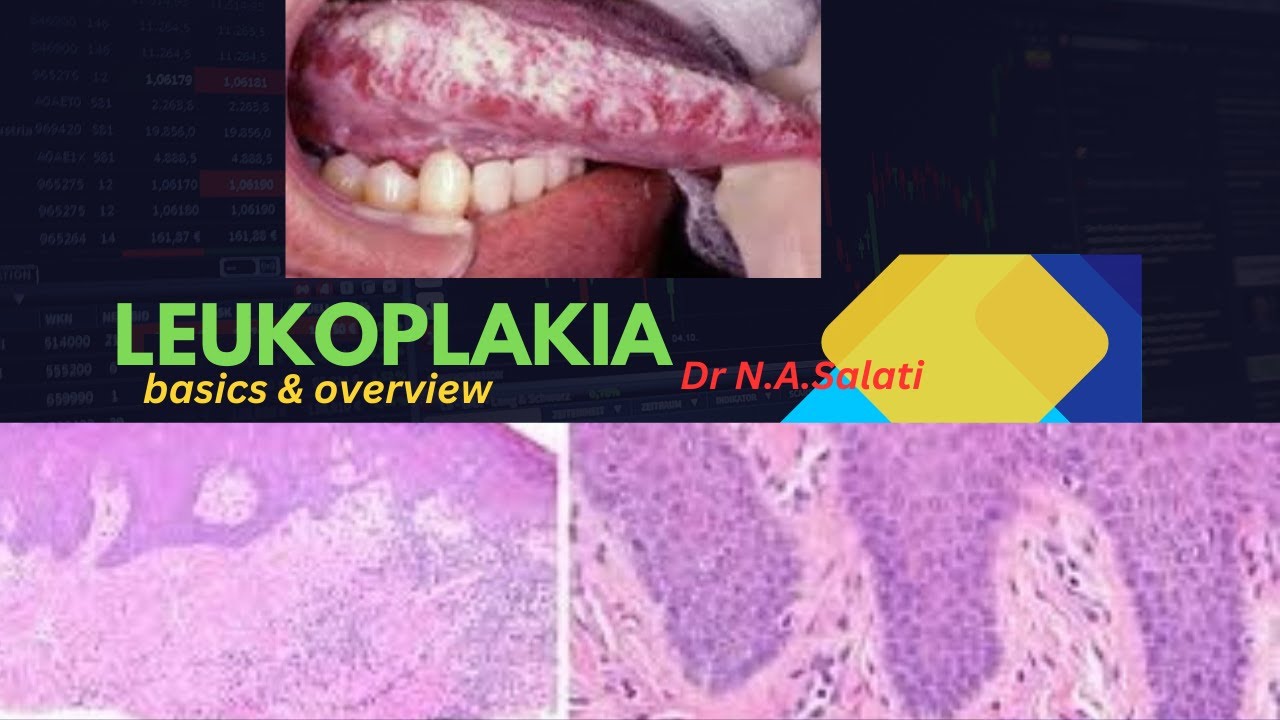 Leukoplakia ....Histopathological Grading - YouTube