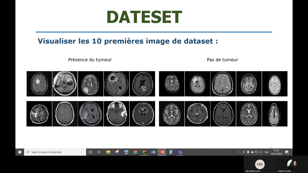 Présentation Mini-project Deep Learning : BRAIN Cancer Détection - YouTube