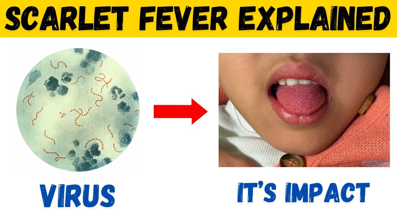 Scarlet Fever a Deadly Disease and it's symptoms - YouTube