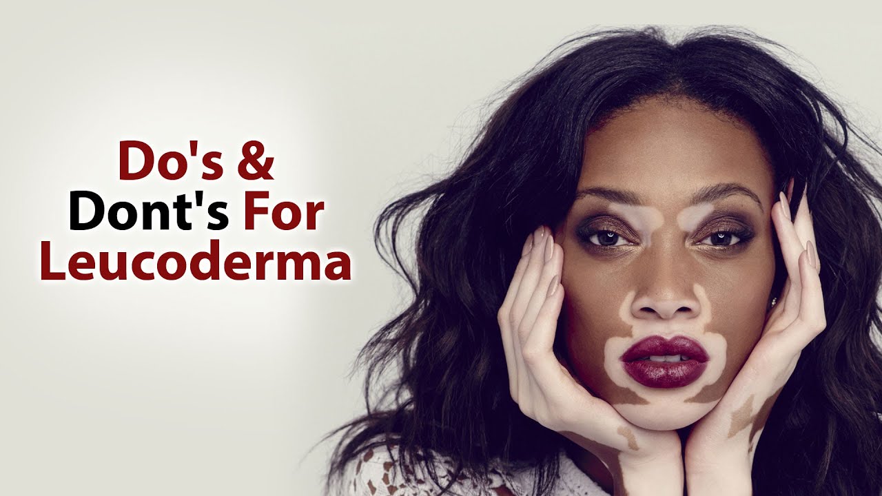 Do's & Dont's For Leucoderma Patient - YouTube
