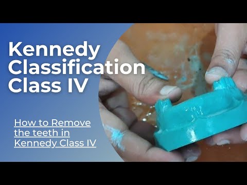 Kennedy classification Class 4| Kennedy Classification| Kennedy ...