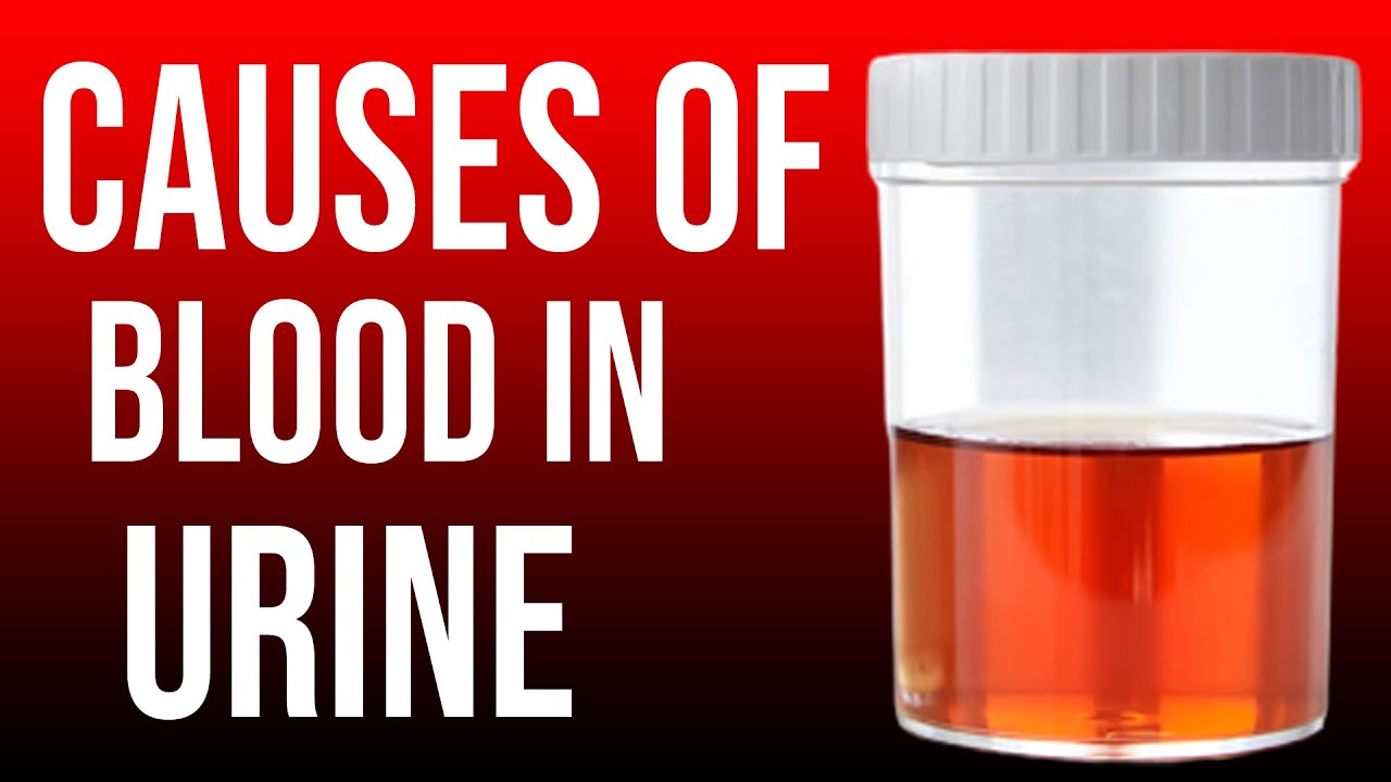 Causes Of Blood In Urine | Hematuria Symptoms | Dr Leela krishna ...