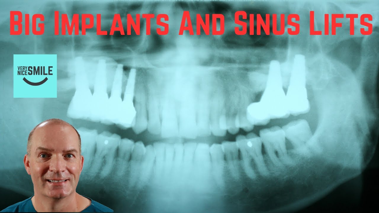 Big Implants and Sinus lifts - YouTube