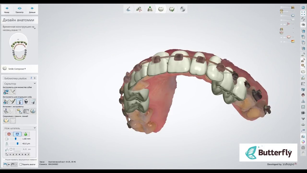 Digital Wax-up 3shape - YouTube