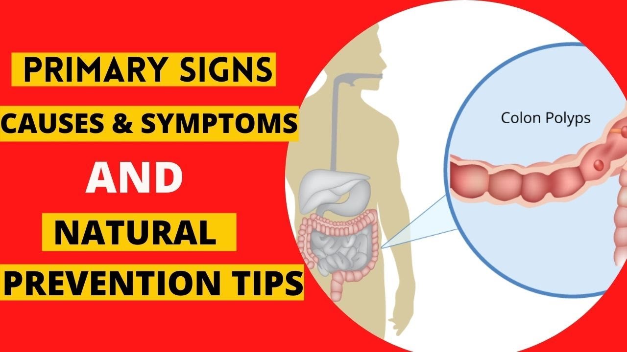 What Is Colon Polyps Signs And Symptoms And Natural Prevention Tips