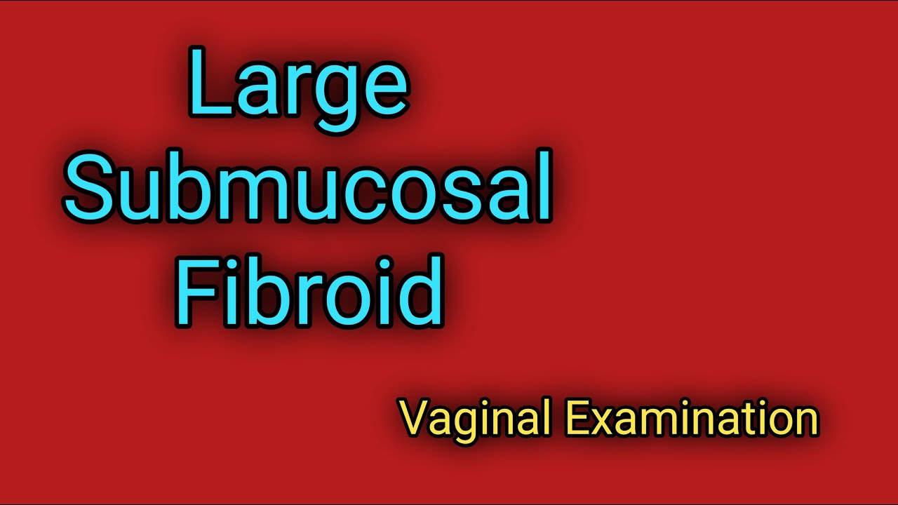 Polymenorrhagia | submucosal uterine fibroid | per-speculum examination ...