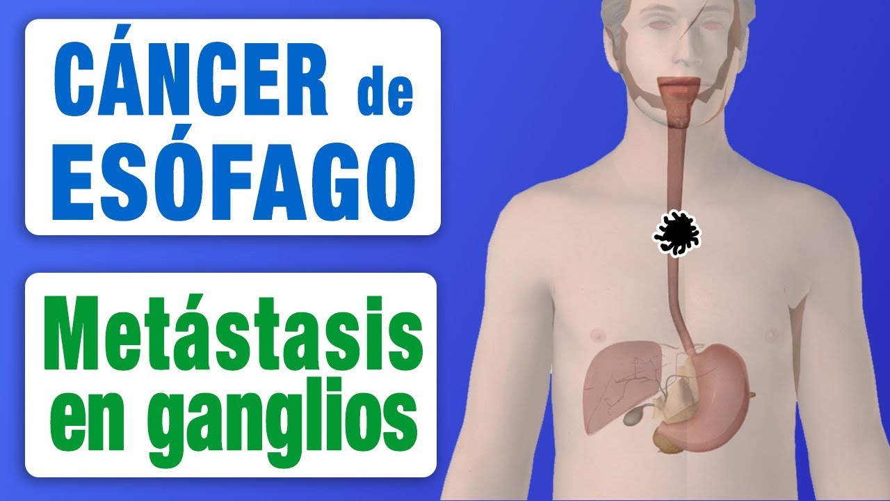 Síntomas del cáncer de esófago - Metástasis en ganglios - YouTube