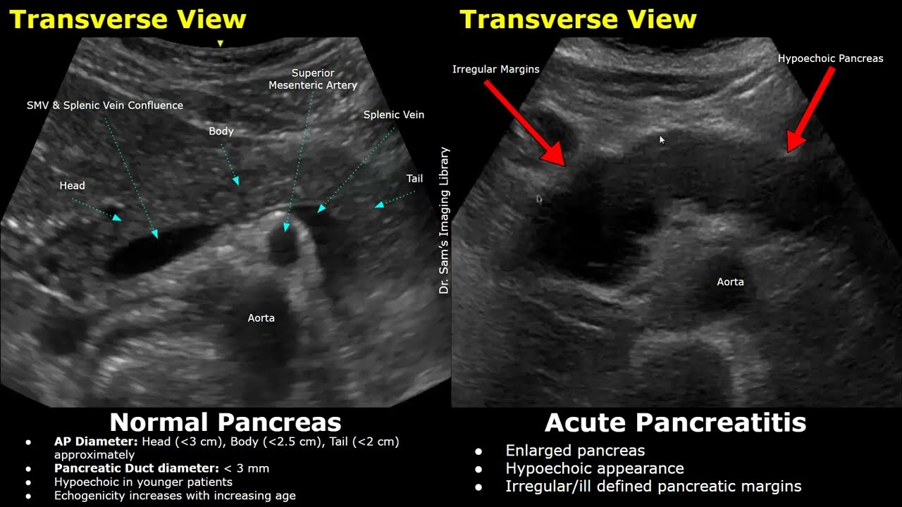 Normal Pancreas And Pancreatic Duct Pancreas Case Pancreatic Exocrine