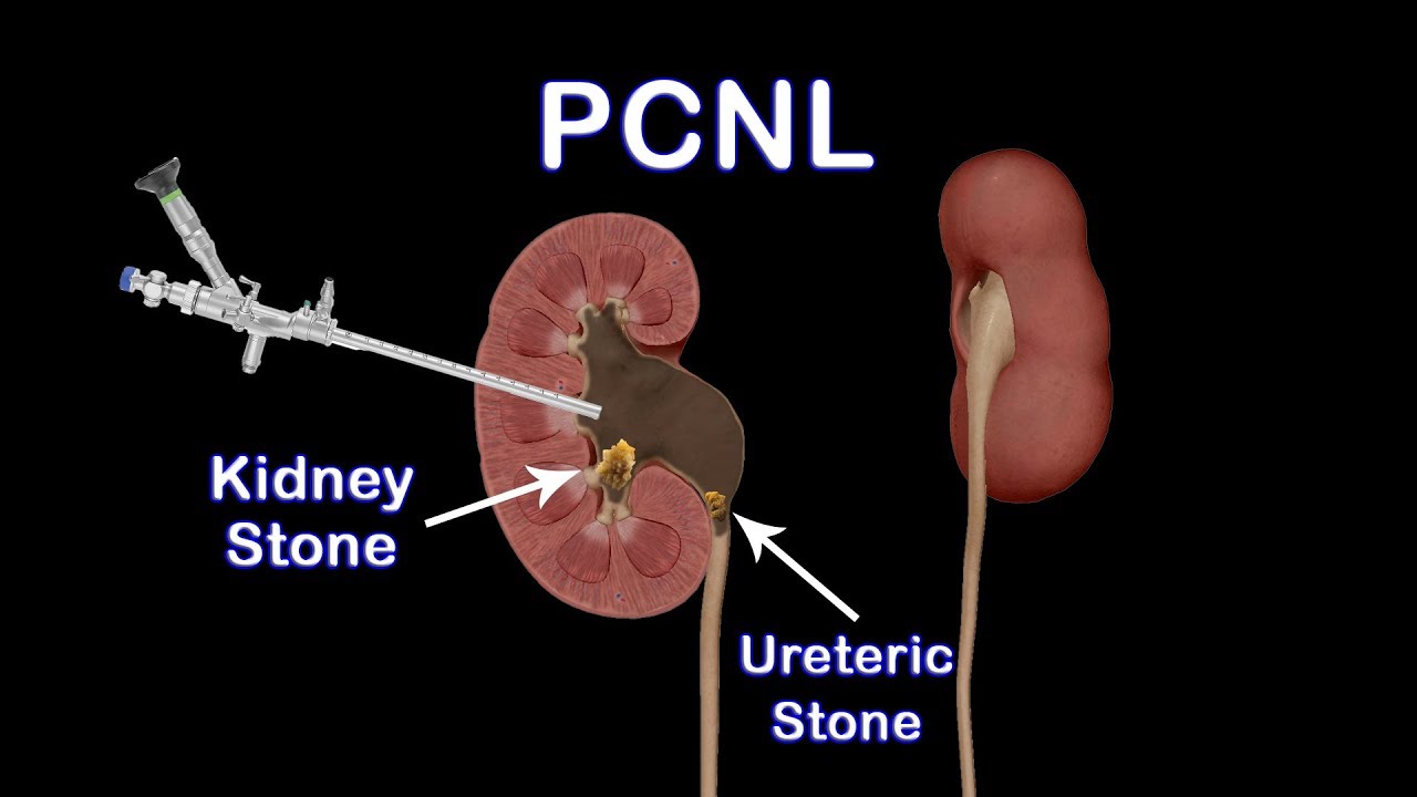 How To Do PCNL For Kidney Stone Removal Surgery 