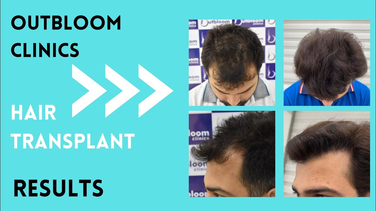 Permanent Hair Transplant | Best Transplant | Outbloom Clinics | Dr ...