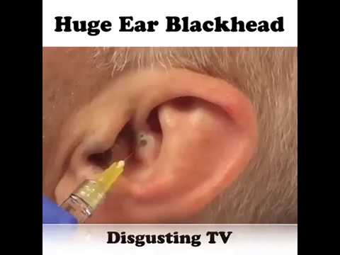 Huge Ear Blackhead | Satisfying Blackhead Removal Compilation - YouTube