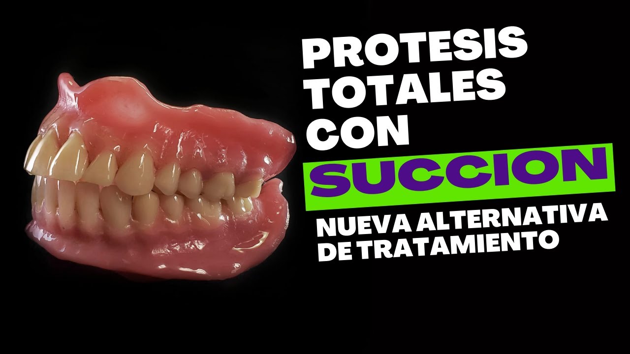 Prótesis Dentales Totales Bimaxilares empleando técnica de succión ...