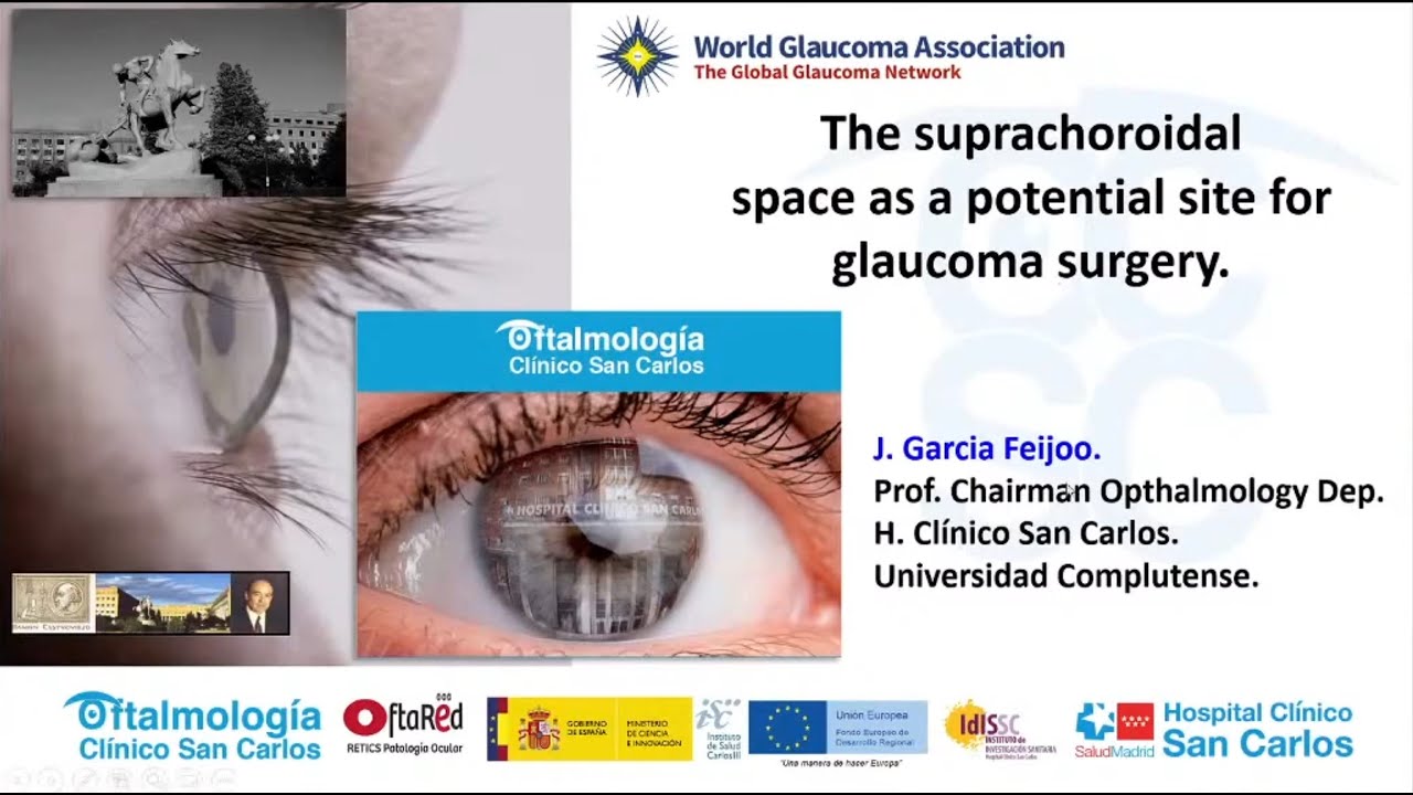 The suprachoroidal space as a potential site for glaucoma surgery - YouTube