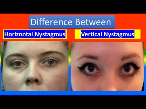 Horizontal Nystagmus Vs Horizontal Nystagmus - YouTube