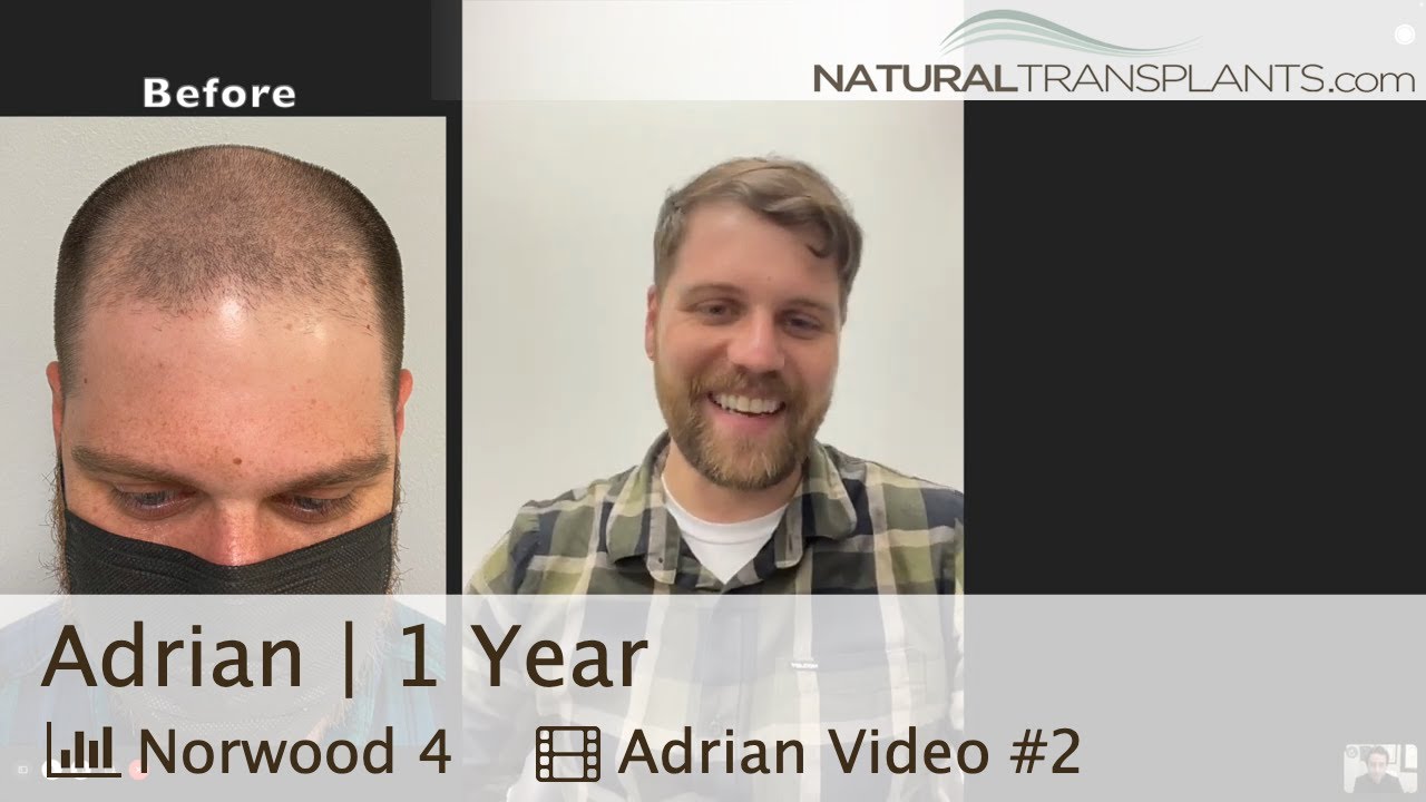 My Hair Transplant is One of the Best Decisions I've Ever Made | Dr ...