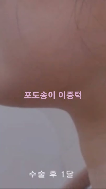 포도송이이중턱 없애기 무보정 3개월차 전후 이중턱근육묶기 이중턱근육묶기 이중턱없애기 얼굴지방흡입 얼굴축소 이중턱