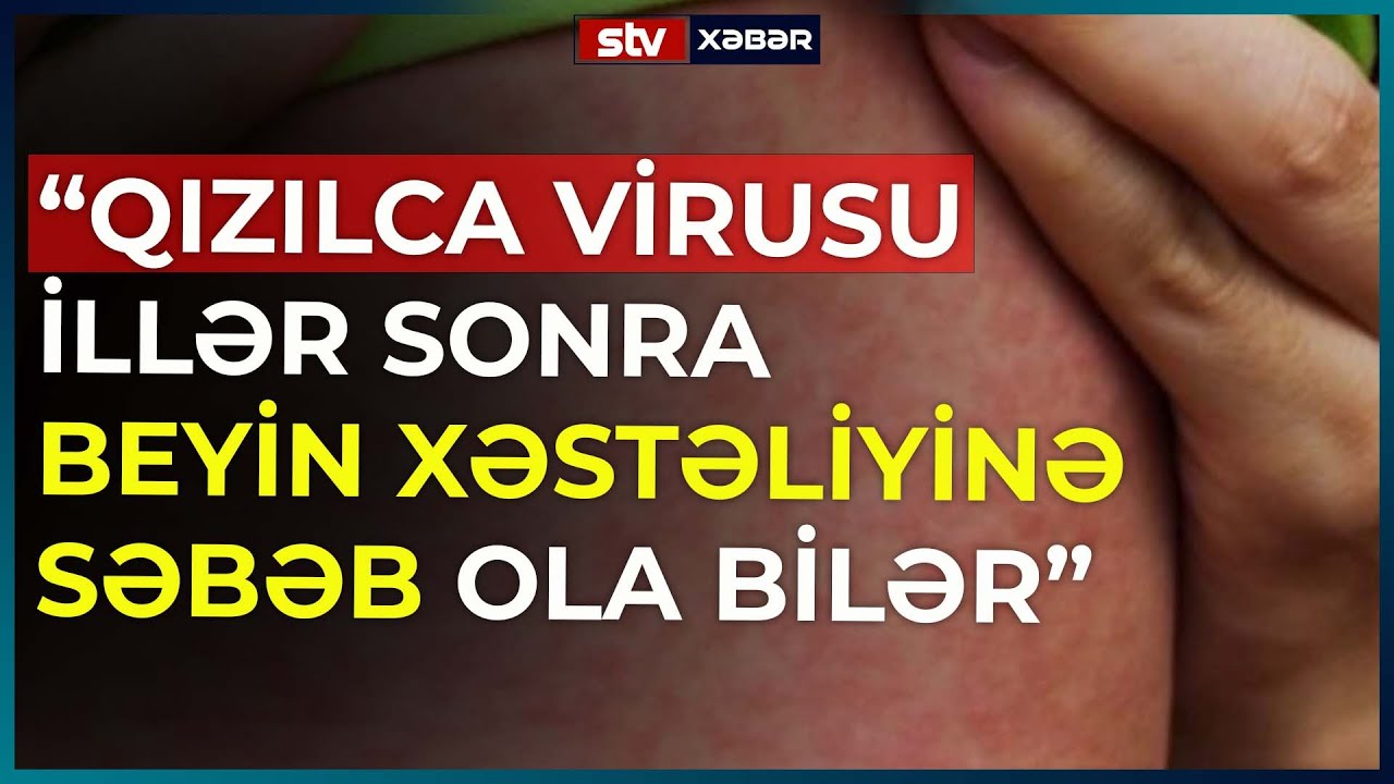 “QIZILCA VİRUSU İLLƏR SONRA BEYİN XƏSTƏLİYİNƏ SƏBƏB OLA BİLƏR” - YouTube