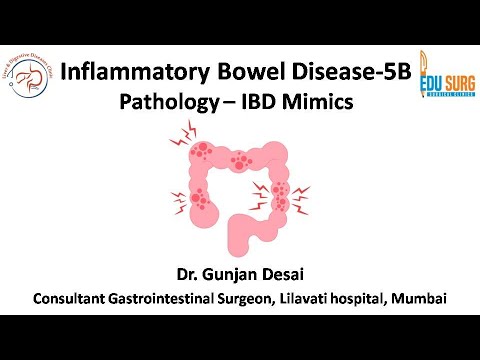 IBD mimics - Crohn's disease and Ulcerative colitis mimics on biopsy ...