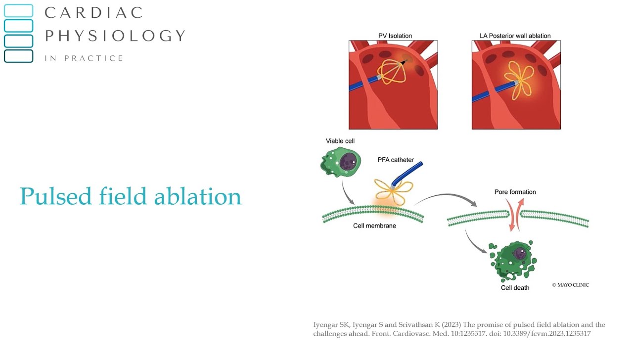 Pulsed Field Ablation for AF - EP in Practice sample - YouTube