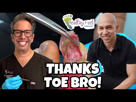 THE TOE BRO HELPED THIS PATIENT HAVE HIS INGROWN TOENAIL REMOVAL !
