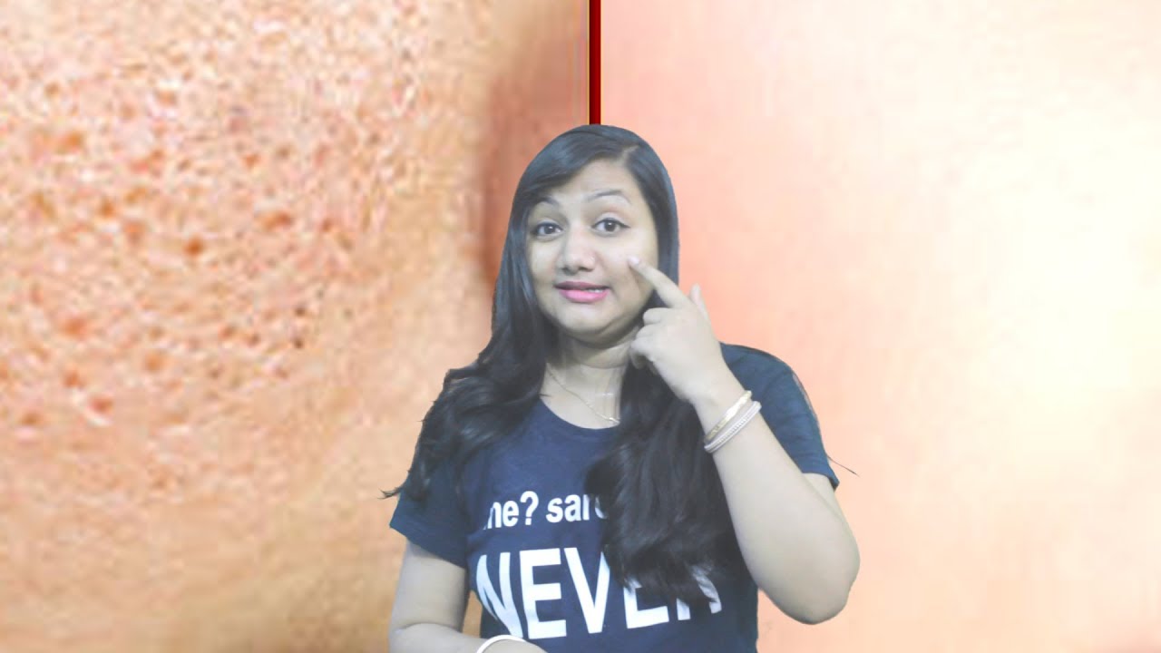 মুখের লোম ছিদ্র বা গর্ত দূর করার সহজ উপায় //probasi bengali vlog - YouTube