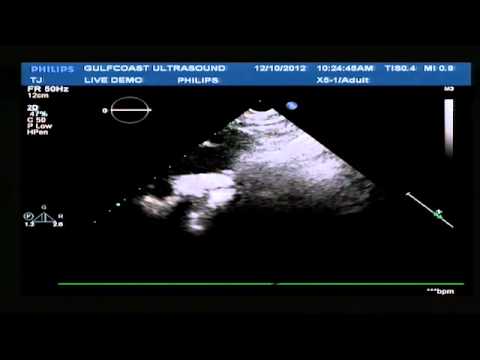 Hot Tips - Finding the Aortic Arch with Ultrasound