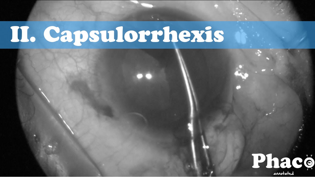 Phaco Annotated | II. Capsulorrhexis - YouTube