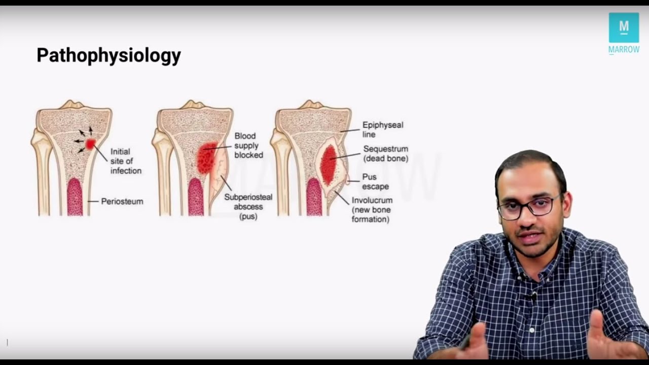 Marrow Master Classes: Orthopaedics Sample Video - Bone Infections ...