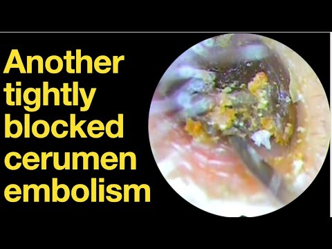Another tightly blocked cerumen embolism|ear wax removal | ear cleaning ...