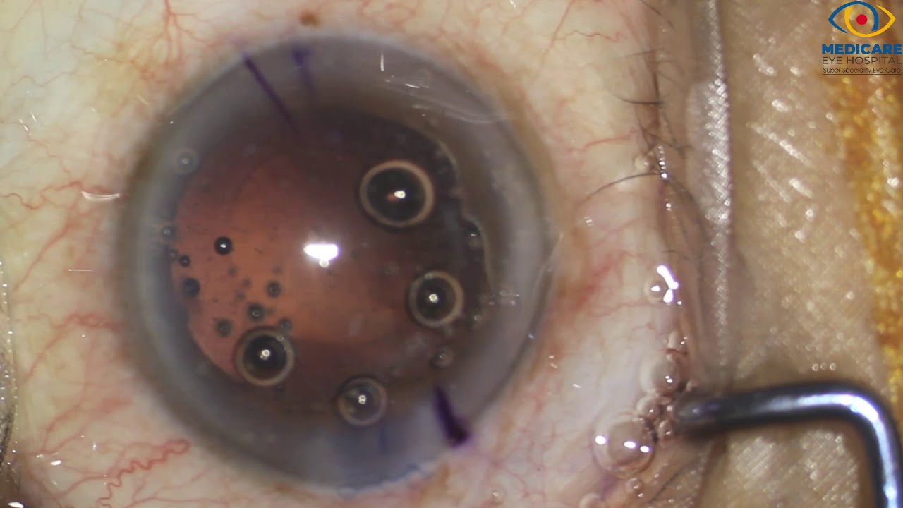 Microincision Cataract Surgery with TORIC Intraocular Lens Implant ...