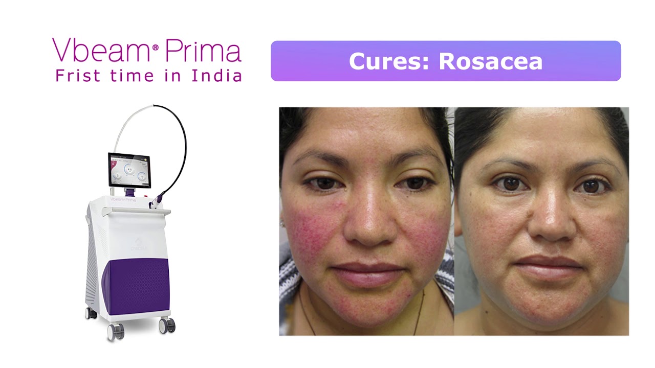 Vbeam Prima Pulse Dye Laser Treatment || Benefits and Features Vbeam ...