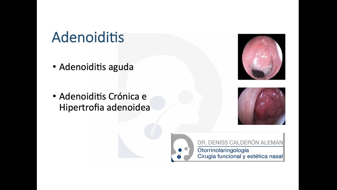 4. Adenoiditis - YouTube