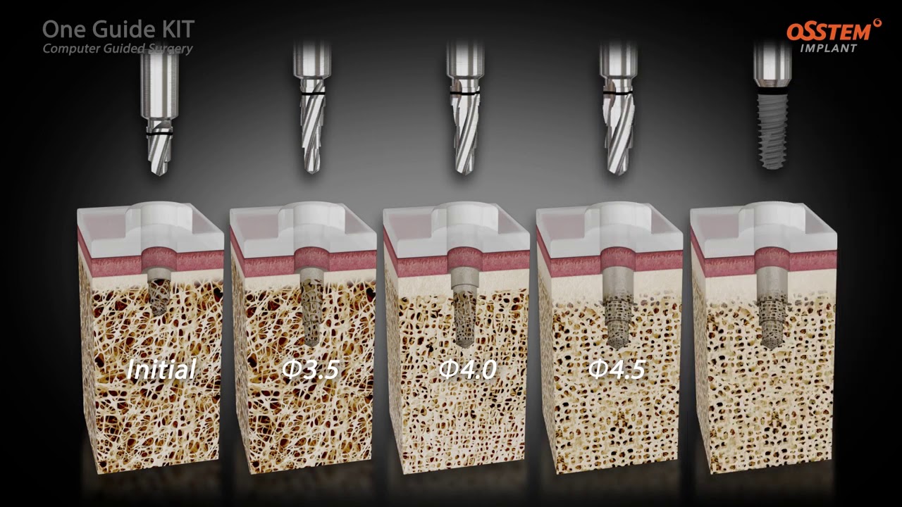 OSSTEM OneGuide RUS - YouTube