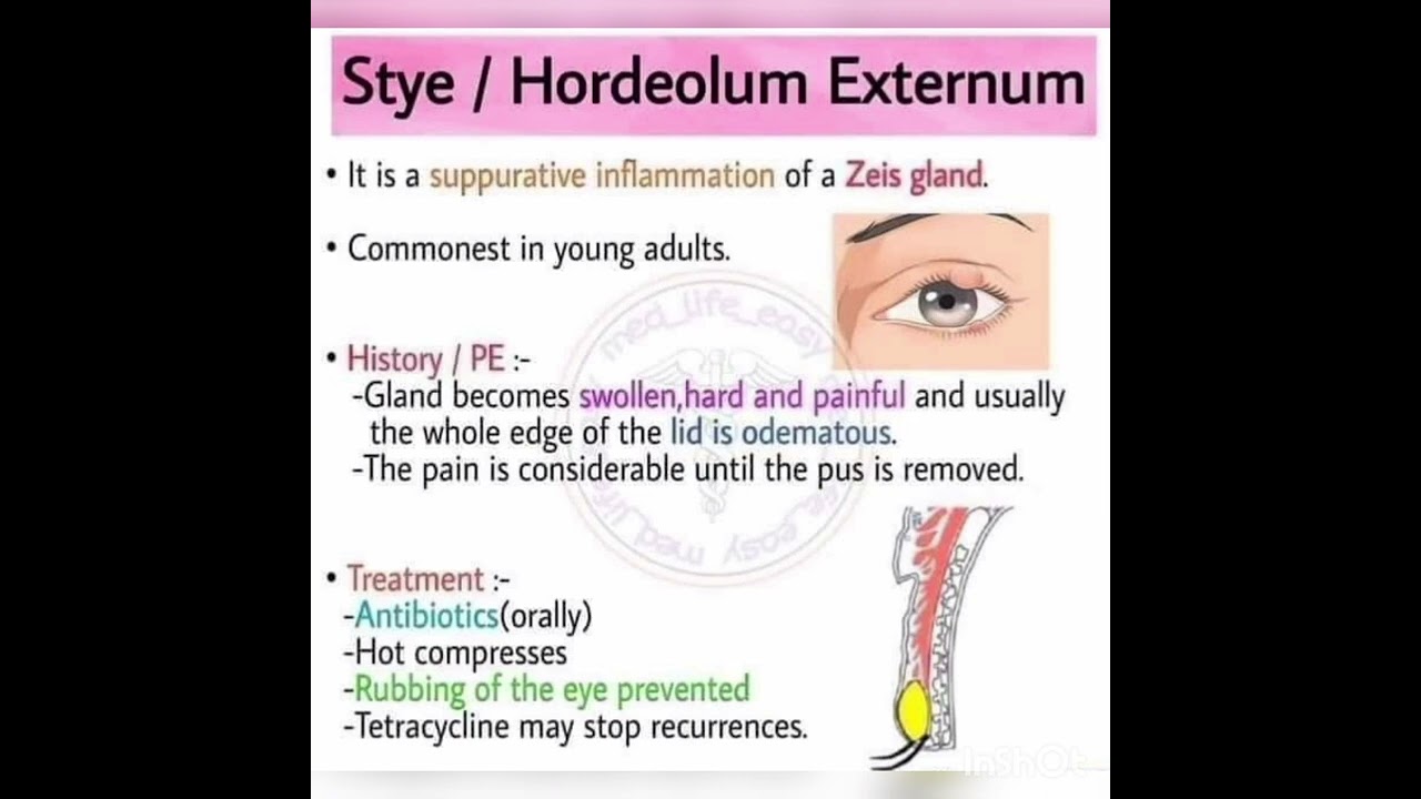 Hordeolum Externum Treatment