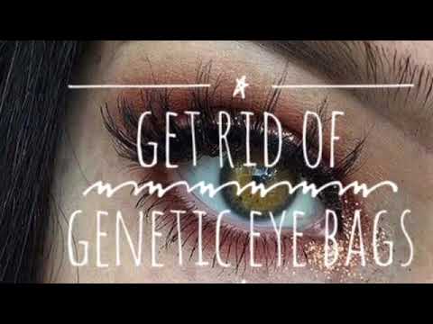 Get rid of genetic eye bags - YouTube