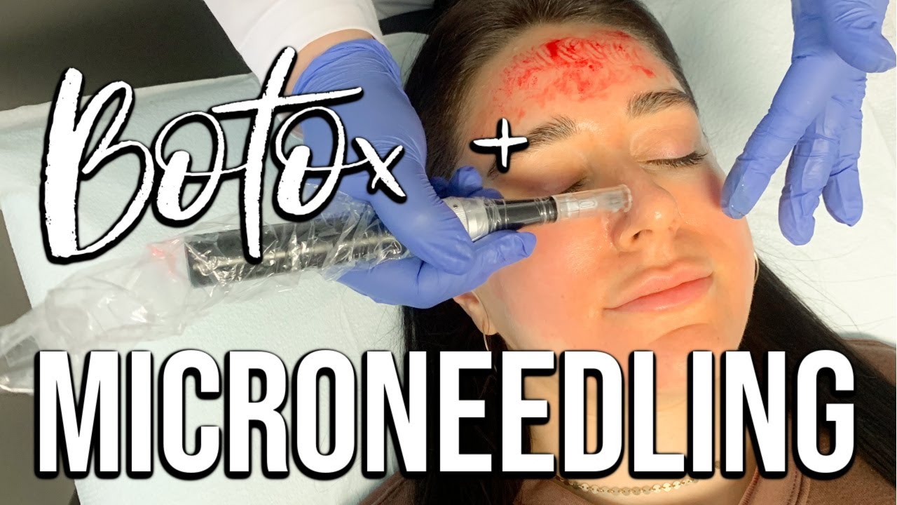 MICRONEEDLING + Botox! | VLOG | My Skin's Healing Process - YouTube
