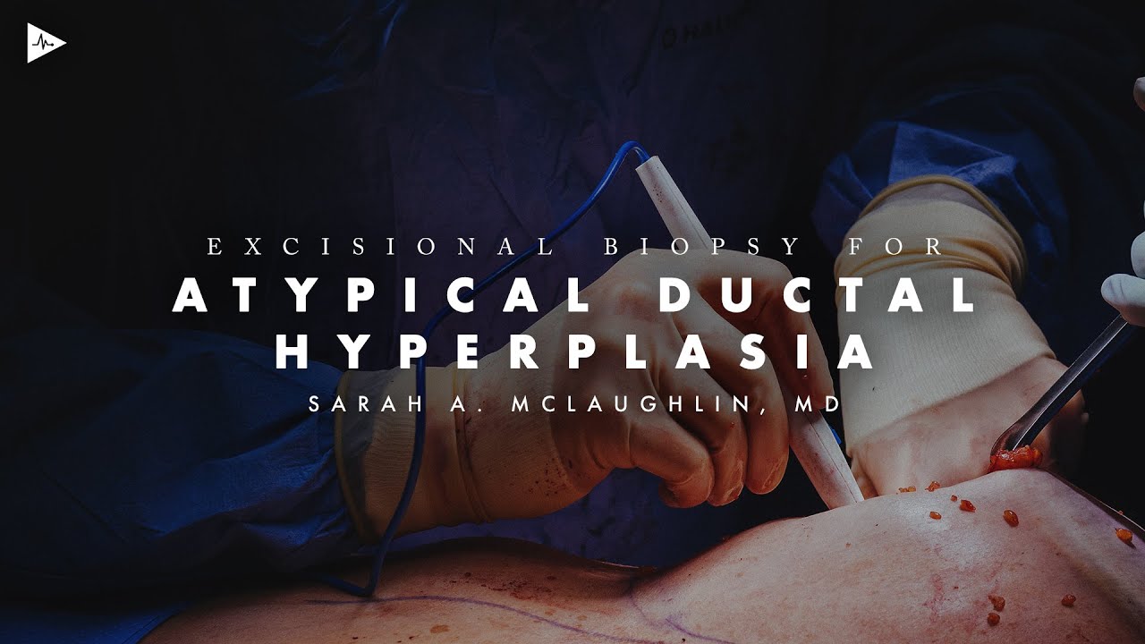 Excisional Biopsy for Atypical Ductal Hyperplasia | Preview - YouTube