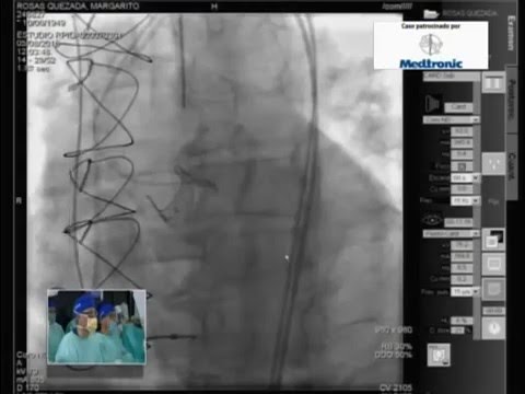 TAVI Corevalve "Valve in Valve" de Medtronic - YouTube