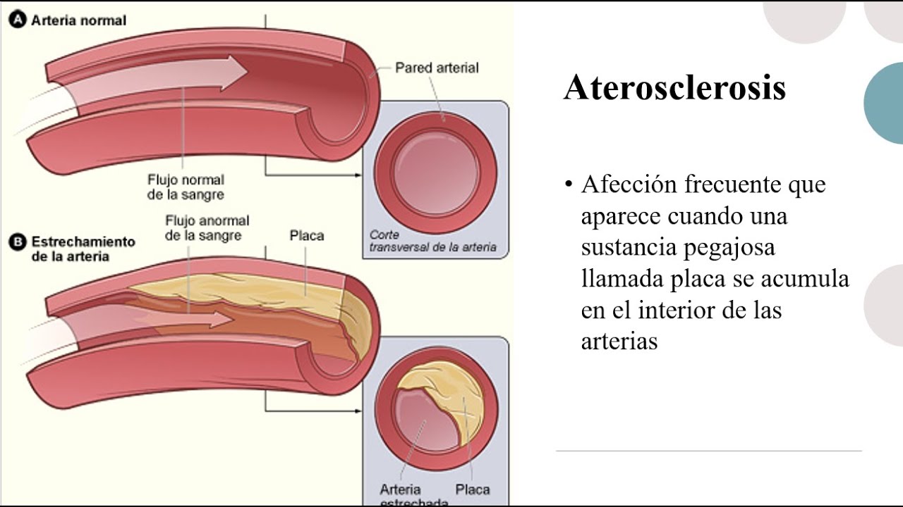 Aterosclerosis ‐ Actividad física y salud - YouTube